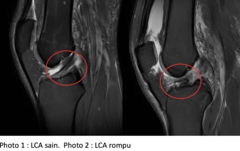 Chirurgie arthroscopique et LCA • Ménisque et ligament croisés