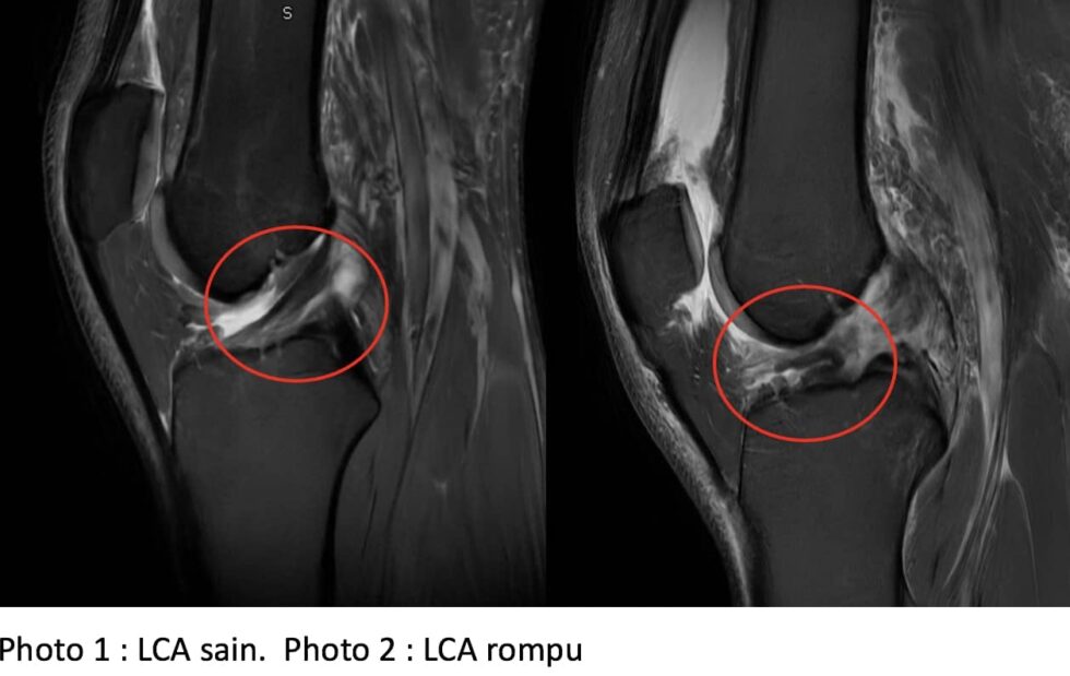 Chirurgie arthroscopique et LCA • Ménisque et ligament croisés